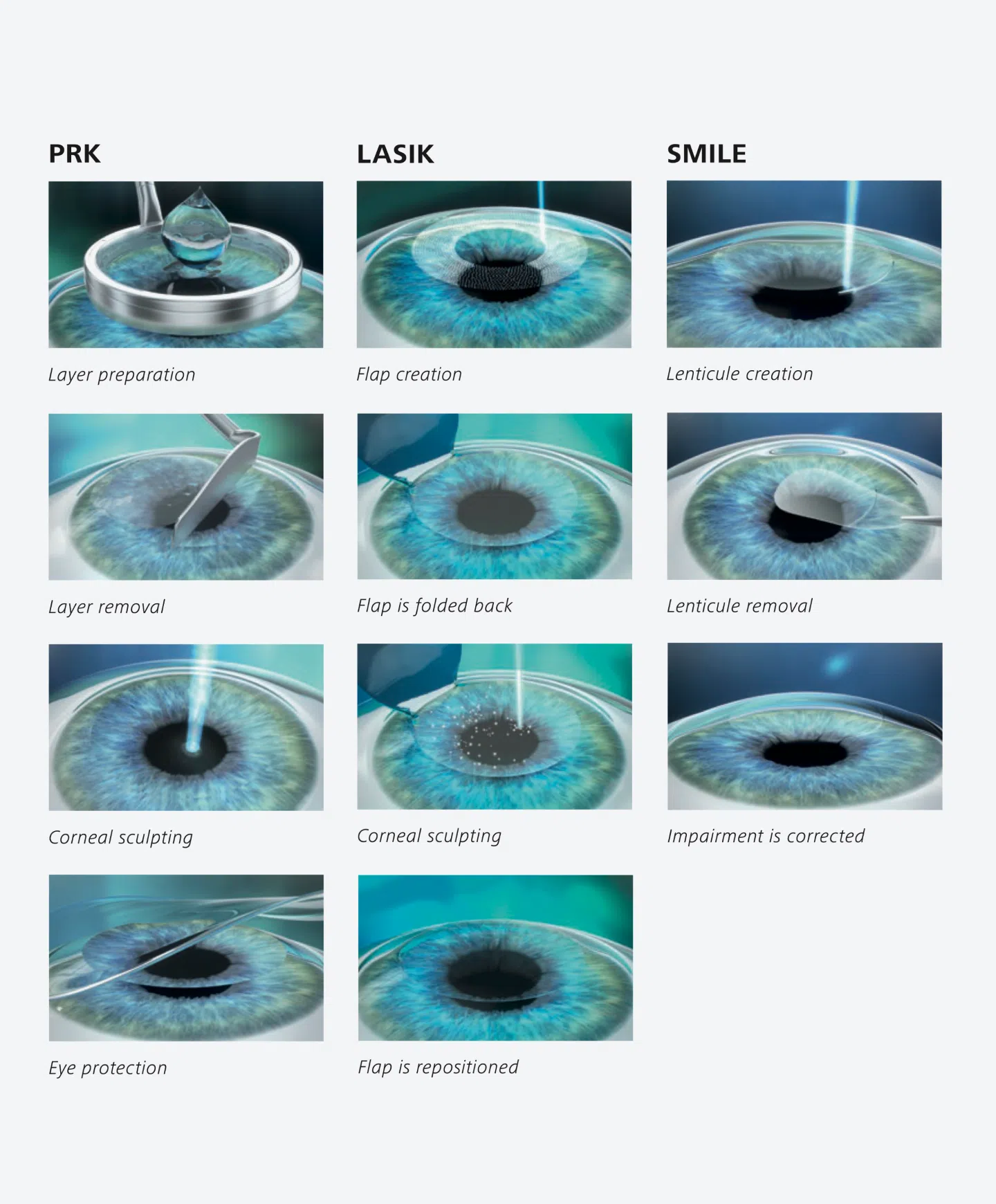 Laser Eye Surgery Sydney | SMILE® Pro, LASIK & PRK Options