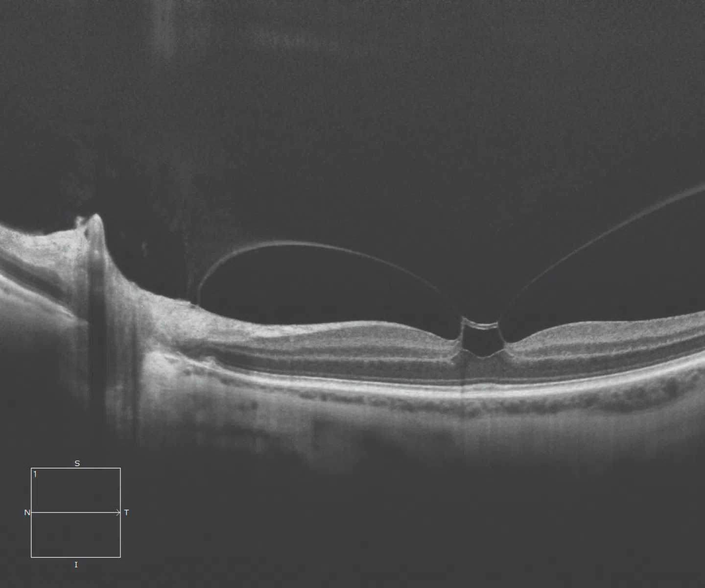 Your Vitreoretinal Surgery Specialists | Eagle Eye Surgeons