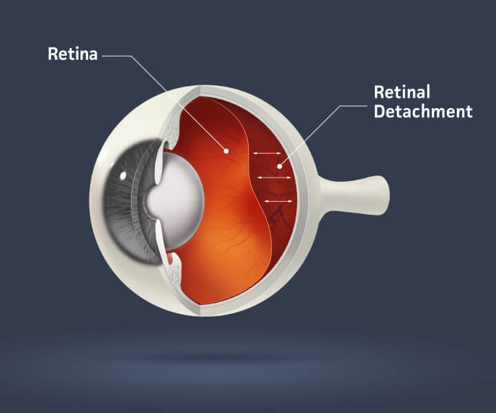 Your Vitreoretinal Surgery Specialists | Eagle Eye Surgeons