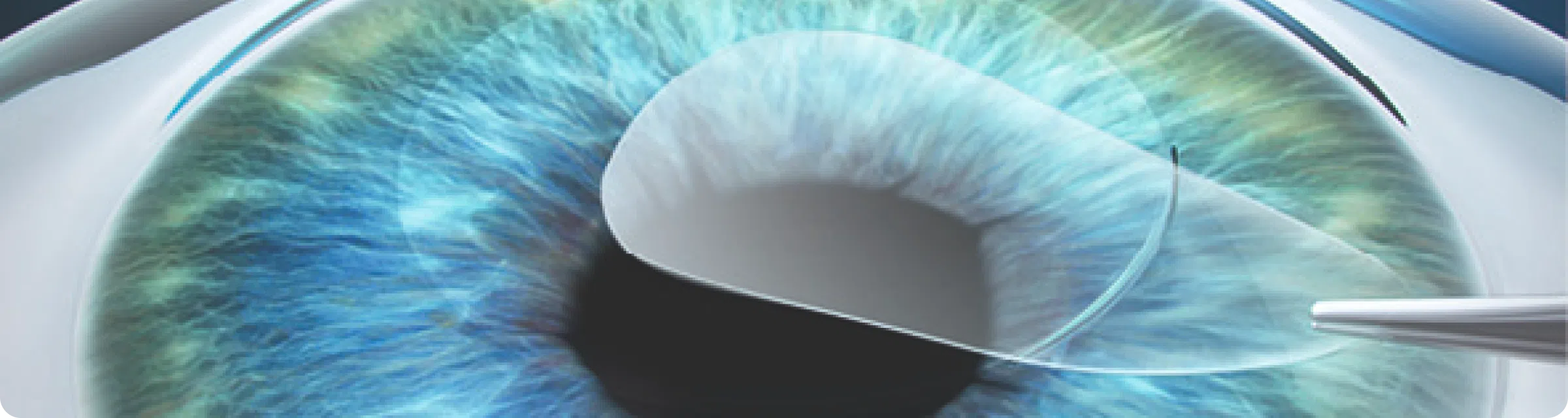 Laser Eye Surgery Sydney | SMILE® Pro, LASIK & PRK Options