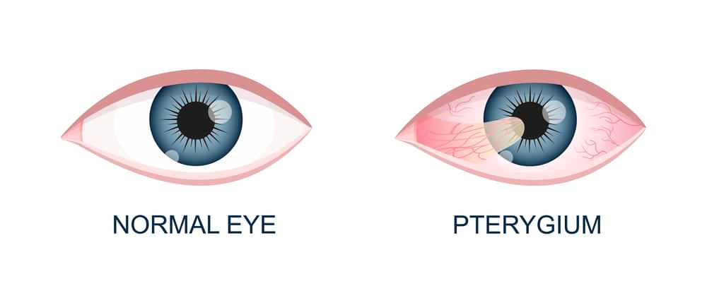 Pterygium Removal and Treatment In Sydney